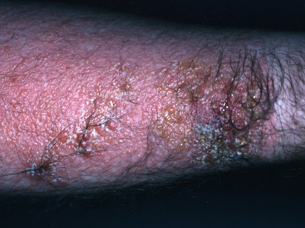 contact dermatitis, poison ivy or oak