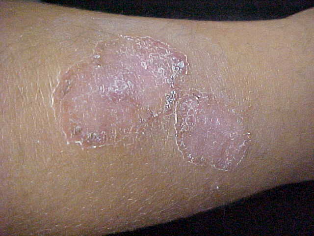 tinea corporis